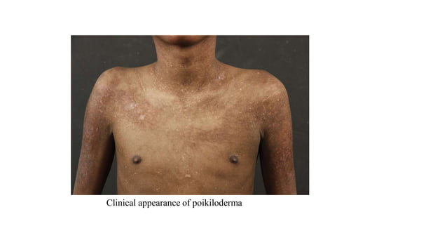Approach to childhood poikiloderma.pptx