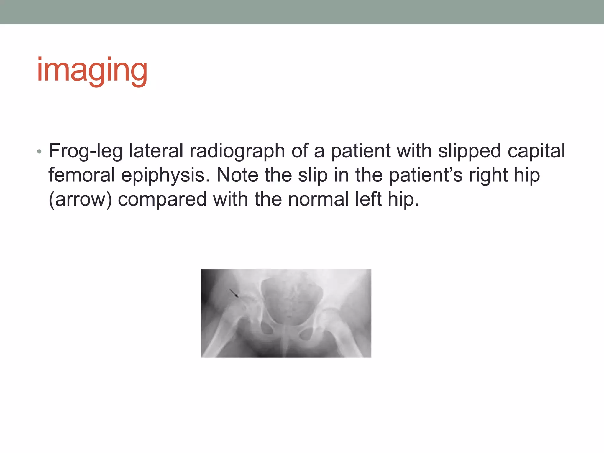 Approach to child with a limp | PPTX