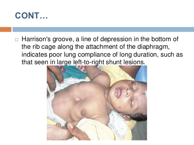 Approach to child with congenital heart disease