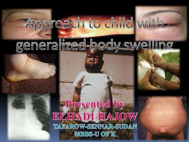 Approach to child with generalized body swelling | PPTX