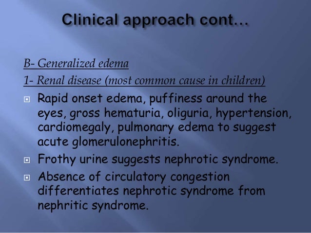 Generalized Edema Generalized And Localized Edema: A Clinical