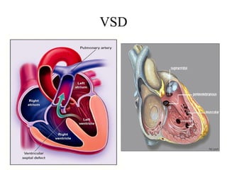 Approach to child with heart disease | PPT