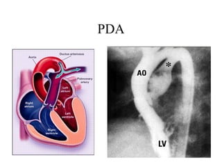 Approach to child with heart disease | PPT