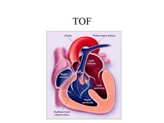 Approach to child with heart disease | PPT