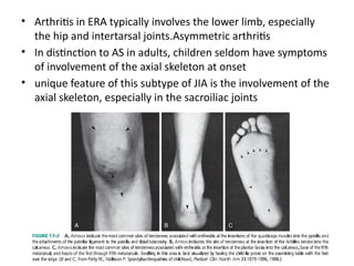 Approach to a child with joint pain hhhh | PPTX