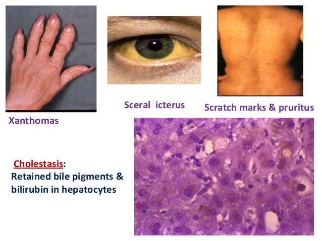 Approach to cholestatic jaundice