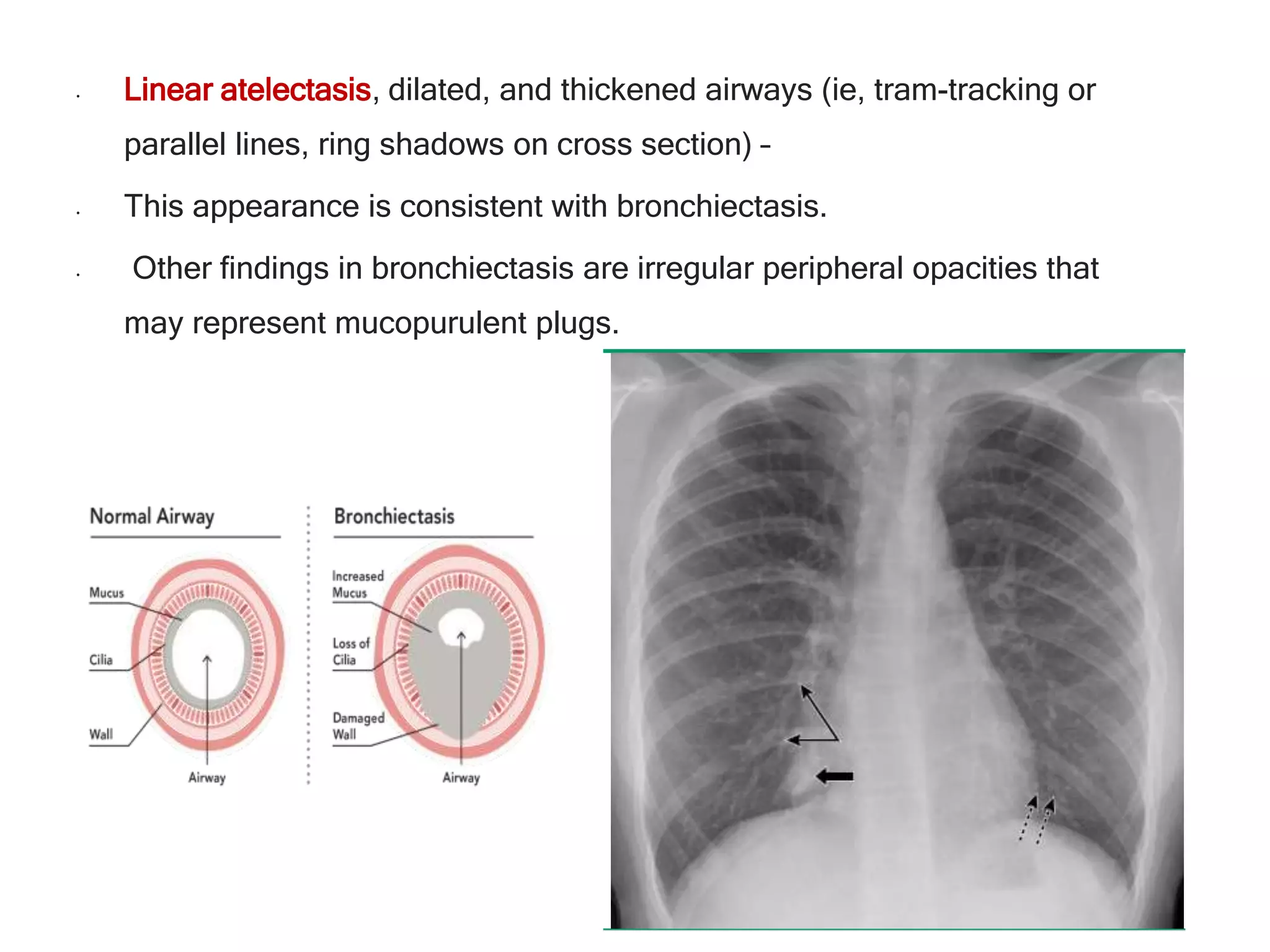 Approach to chronic cough in children | PPTX