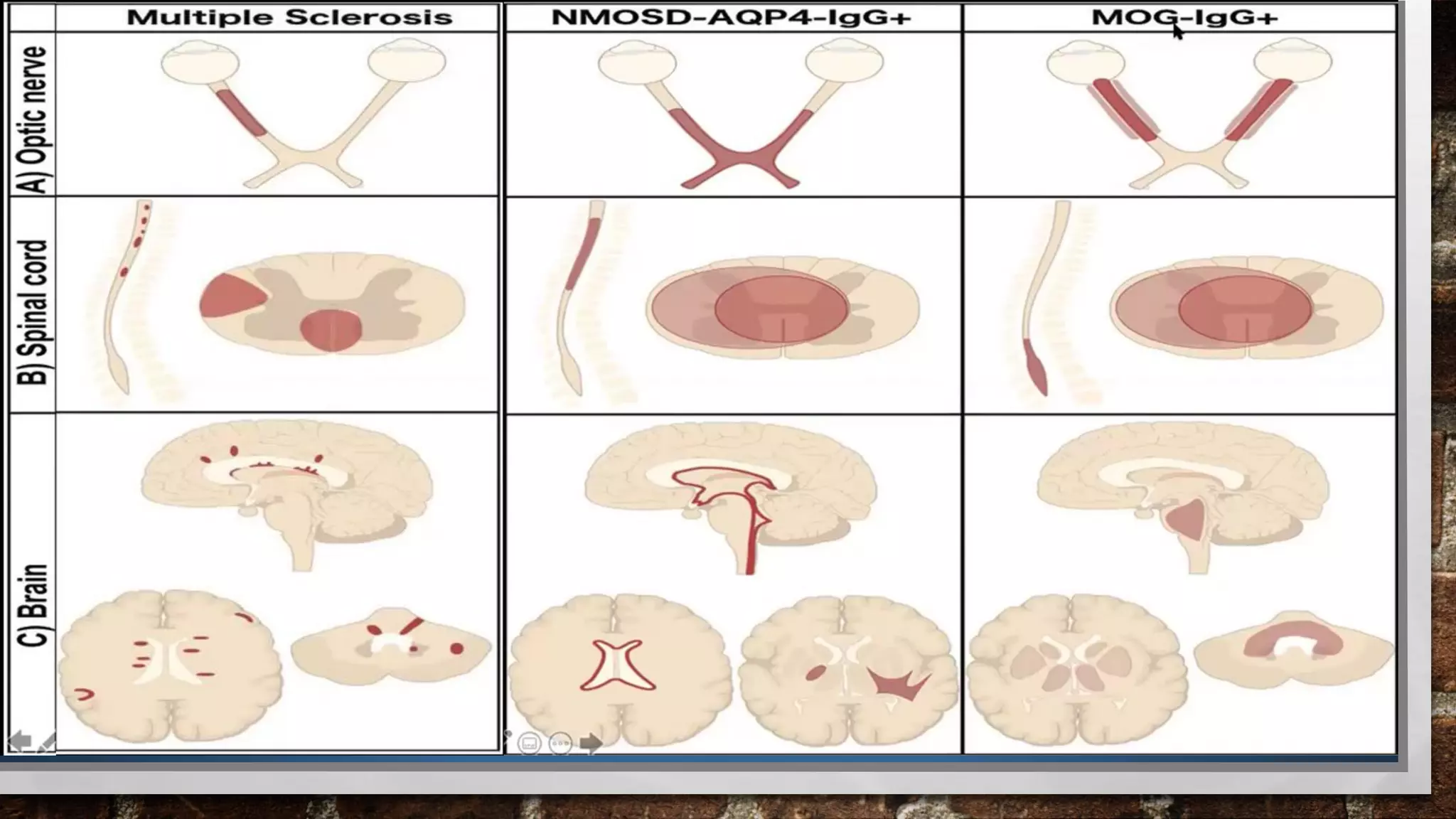 'Approach to cns demyelinating disorders | PDF