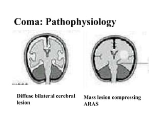 approach_to_coma.ppt