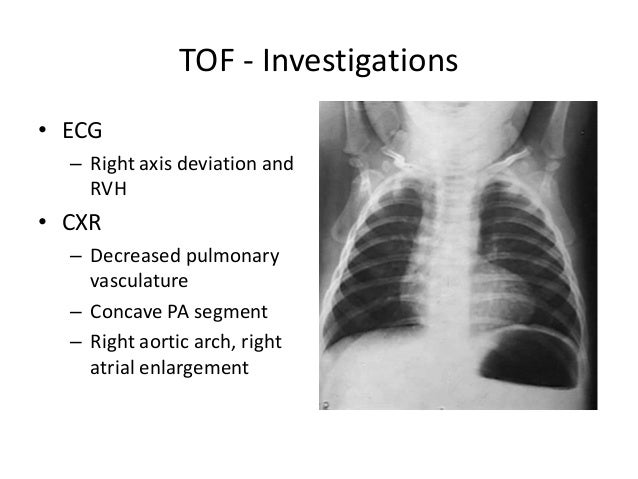 Approach to congenital cyanotic heart diseases