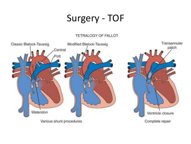 Approach to congenital cyanotic heart diseases