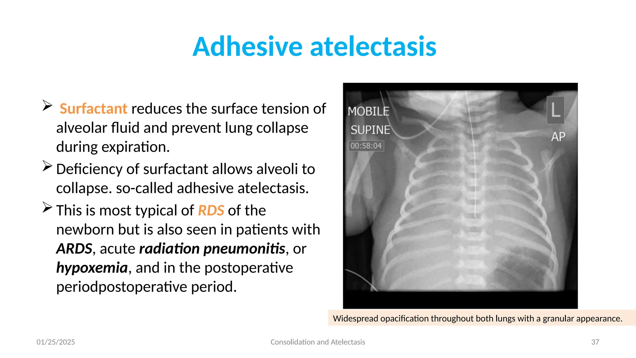 Approach to consolidation and atelectasis .pptx