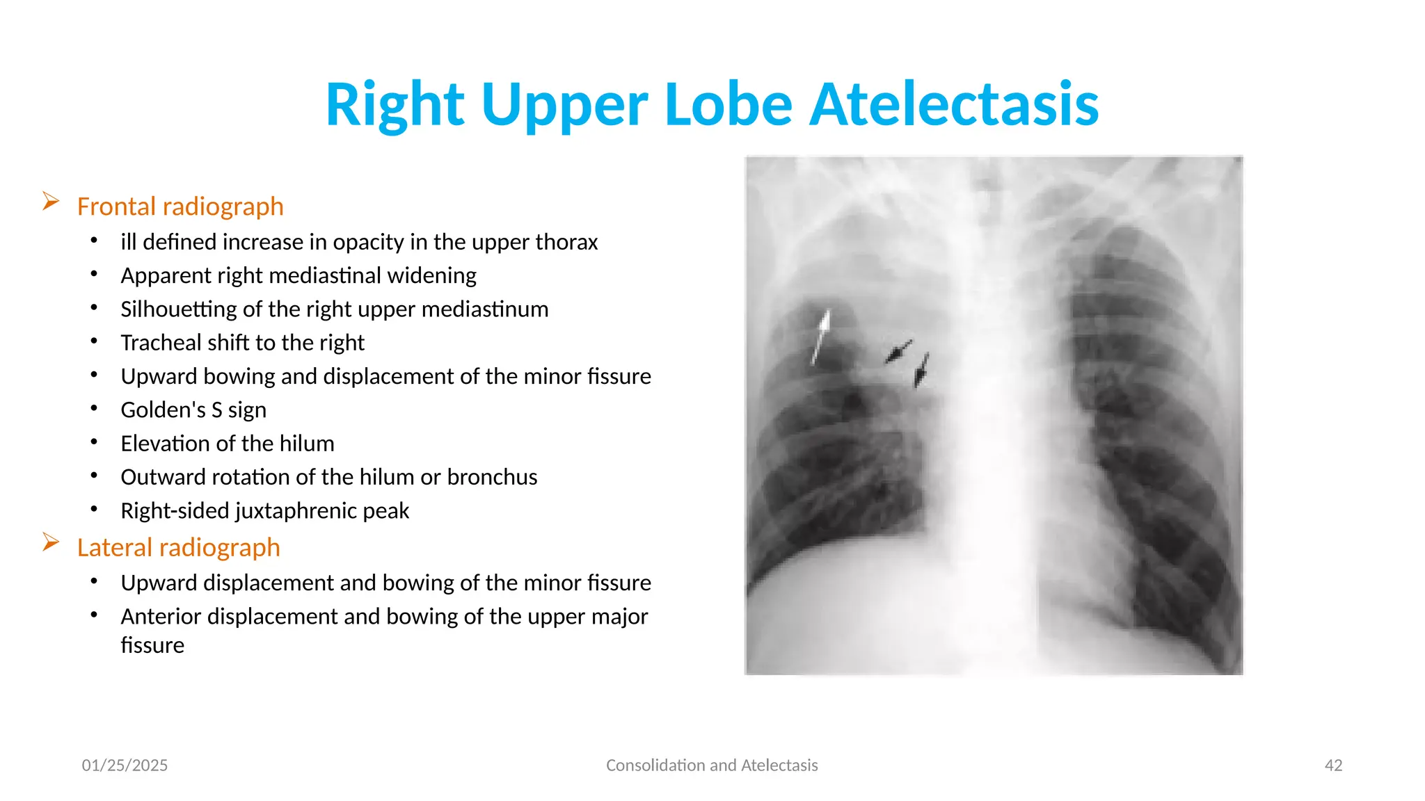 Approach to consolidation and atelectasis .pptx