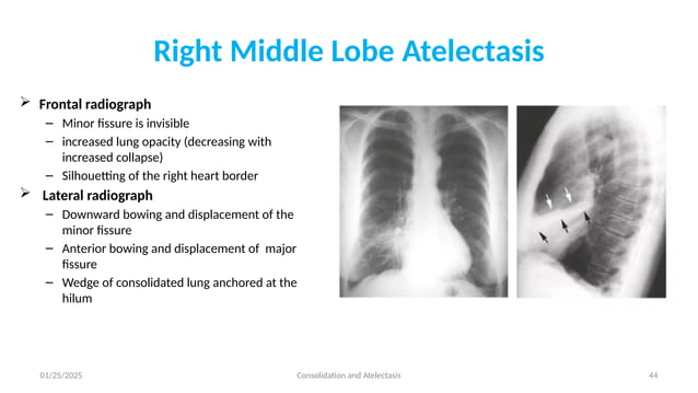 Approach to consolidation and atelectasis .pptx