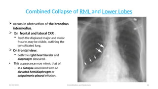 Approach to consolidation and atelectasis .pptx