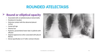 Approach to consolidation and atelectasis .pptx