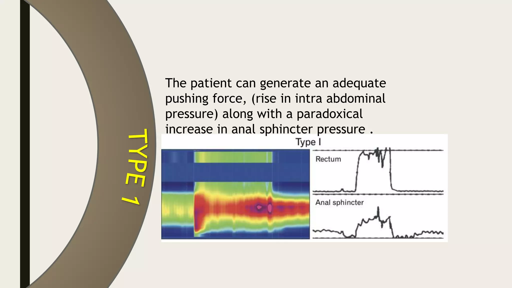 Approach to constipation.pptx