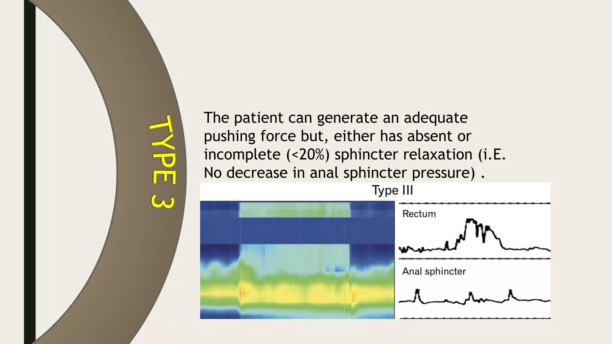 Approach to constipation.pptx