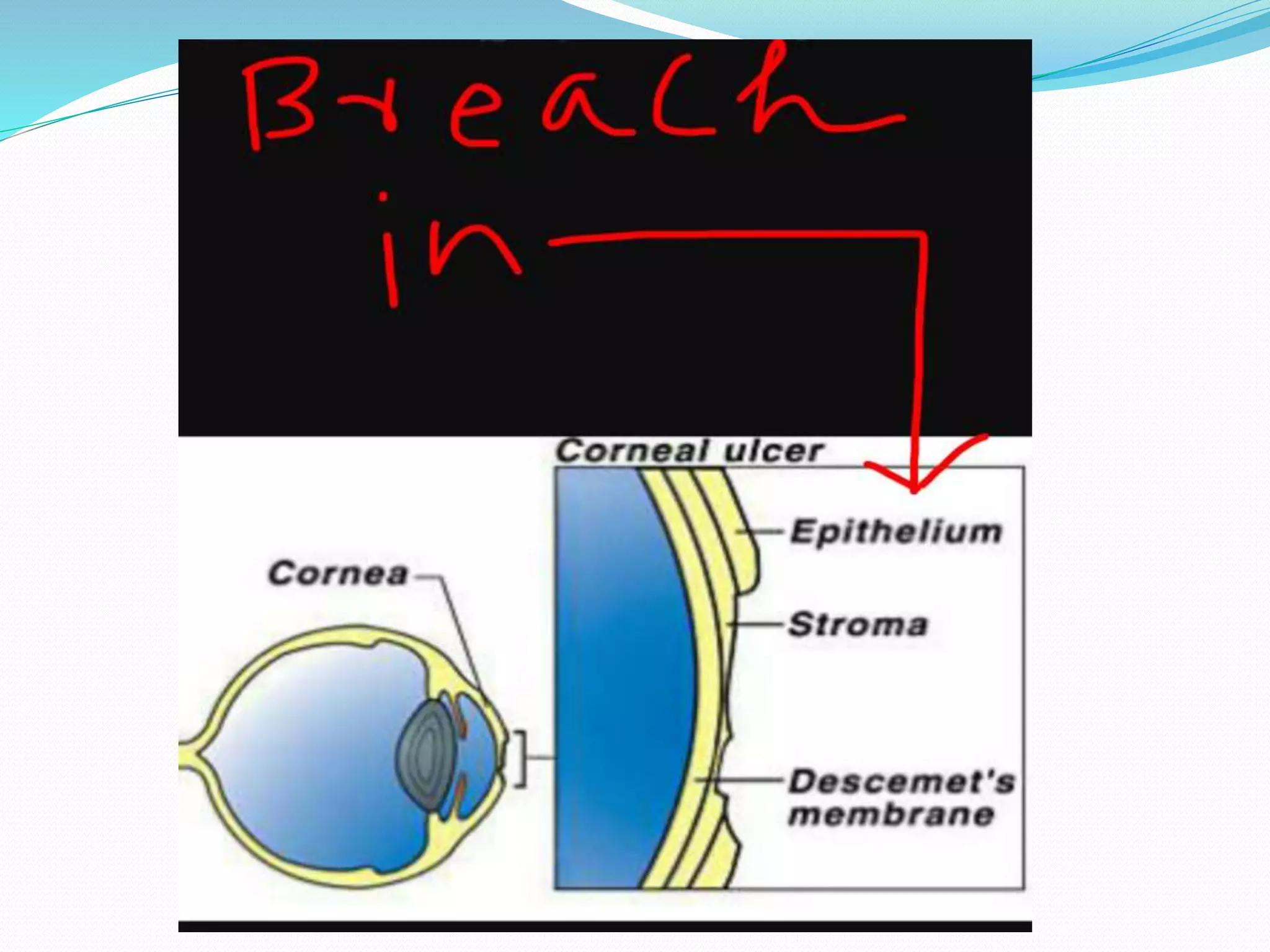 APPROACH TO CORNEAL ULCER.pptx
