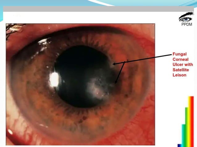APPROACH TO CORNEAL ULCER.pptx