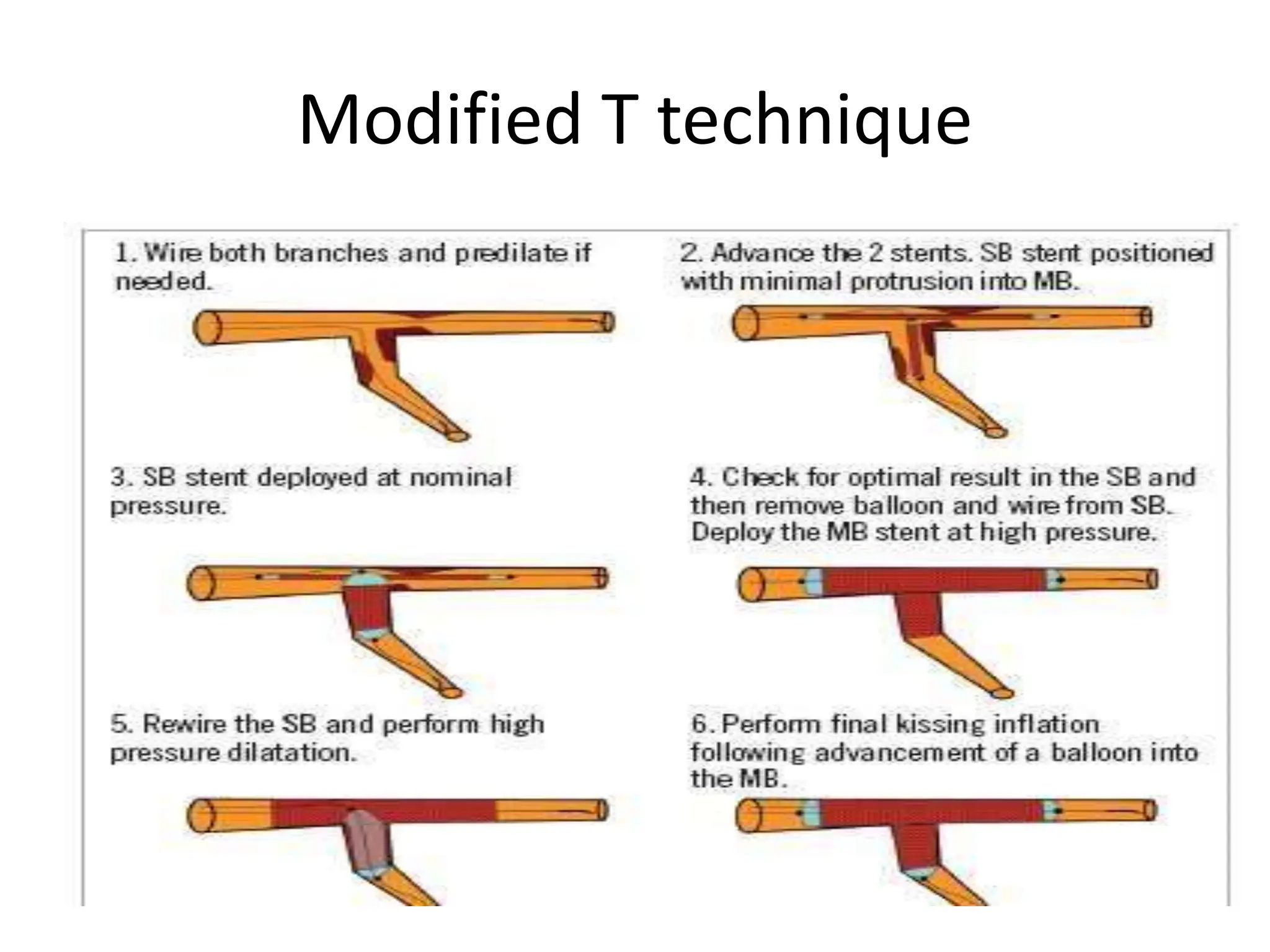 APPROACH TO CORONARY BIFURCATION LESIONS-DR SANTHOSH 2 (1).pptx