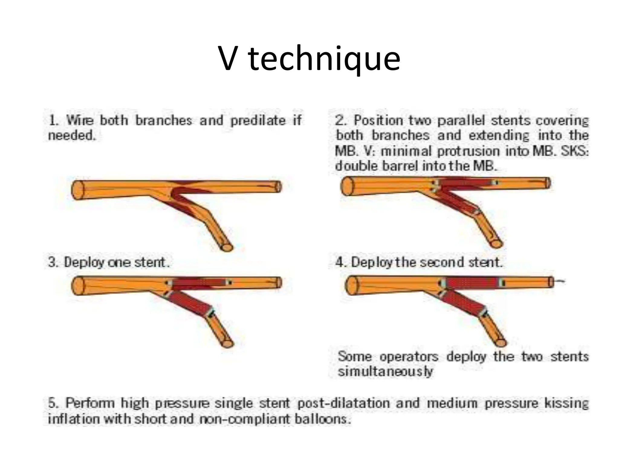 APPROACH TO CORONARY BIFURCATION LESIONS-DR SANTHOSH 2 (1).pptx
