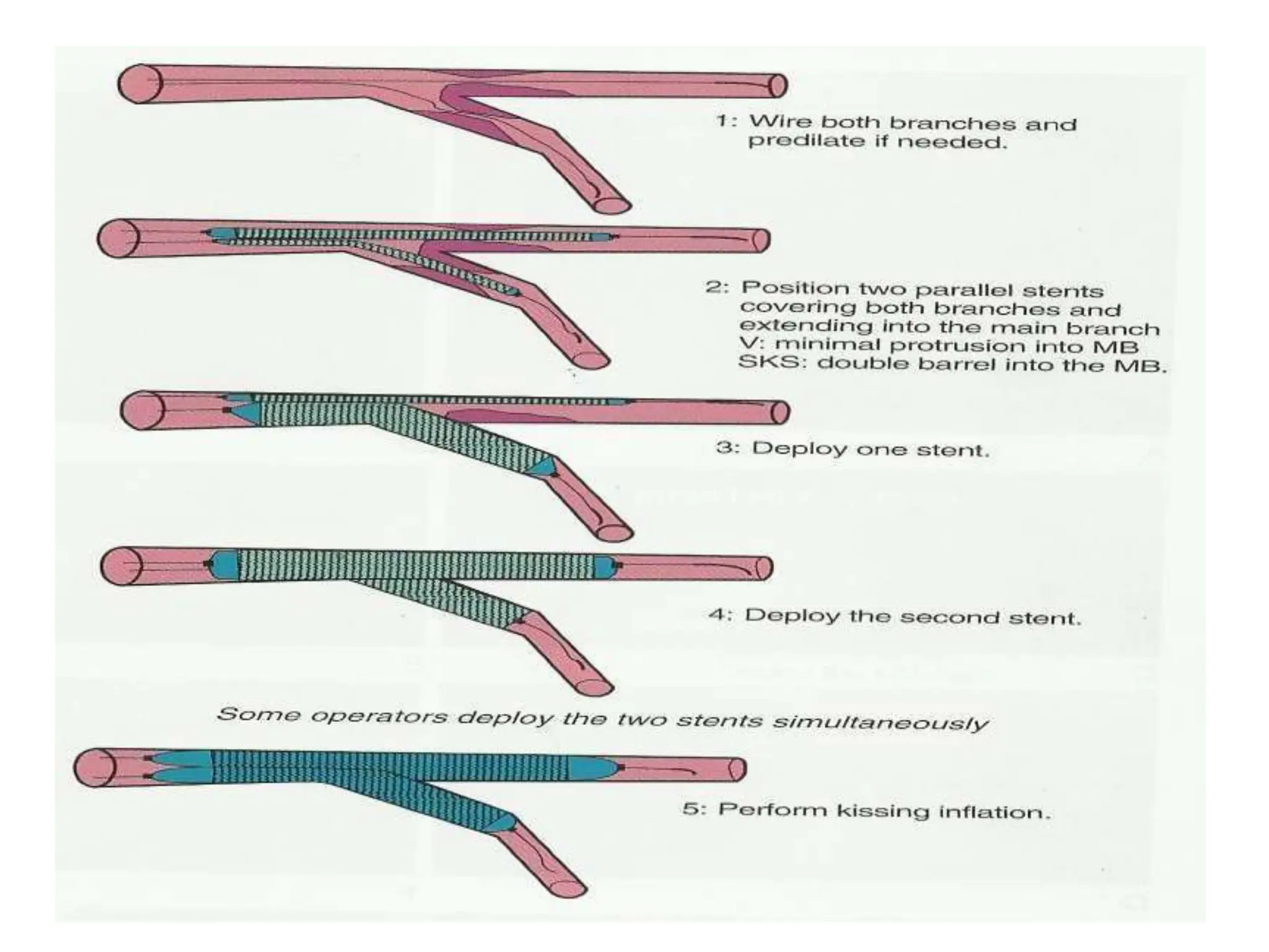 APPROACH TO CORONARY BIFURCATION LESIONS-DR SANTHOSH 2 (1).pptx