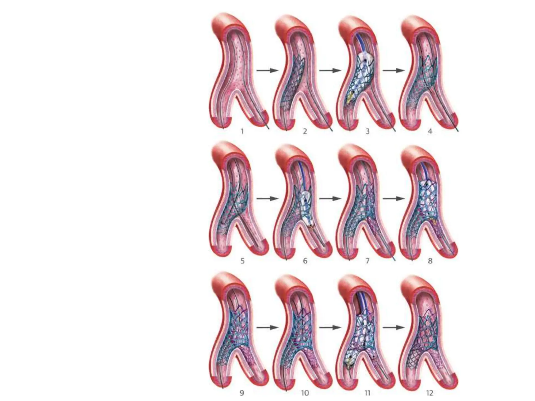 APPROACH TO CORONARY BIFURCATION LESIONS-DR SANTHOSH 2 (1).pptx