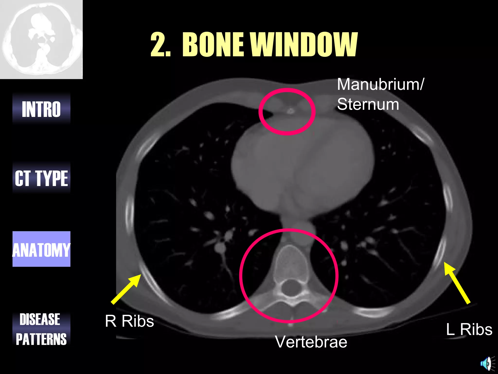 Approach to ct chest 578 | PPT