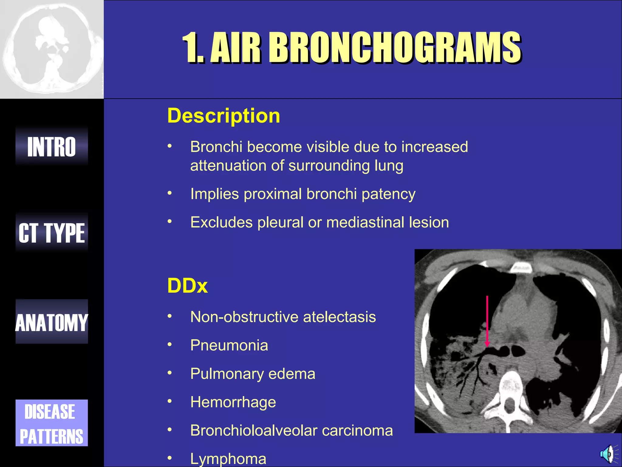 Approach to ct chest 578 | PPT