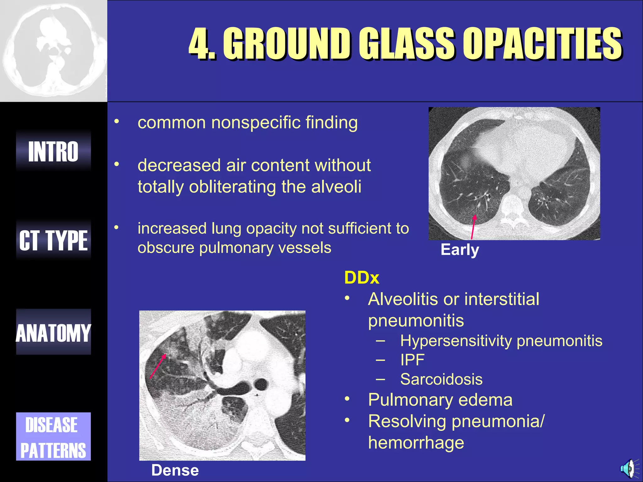 Approach to ct chest 578 | PPT