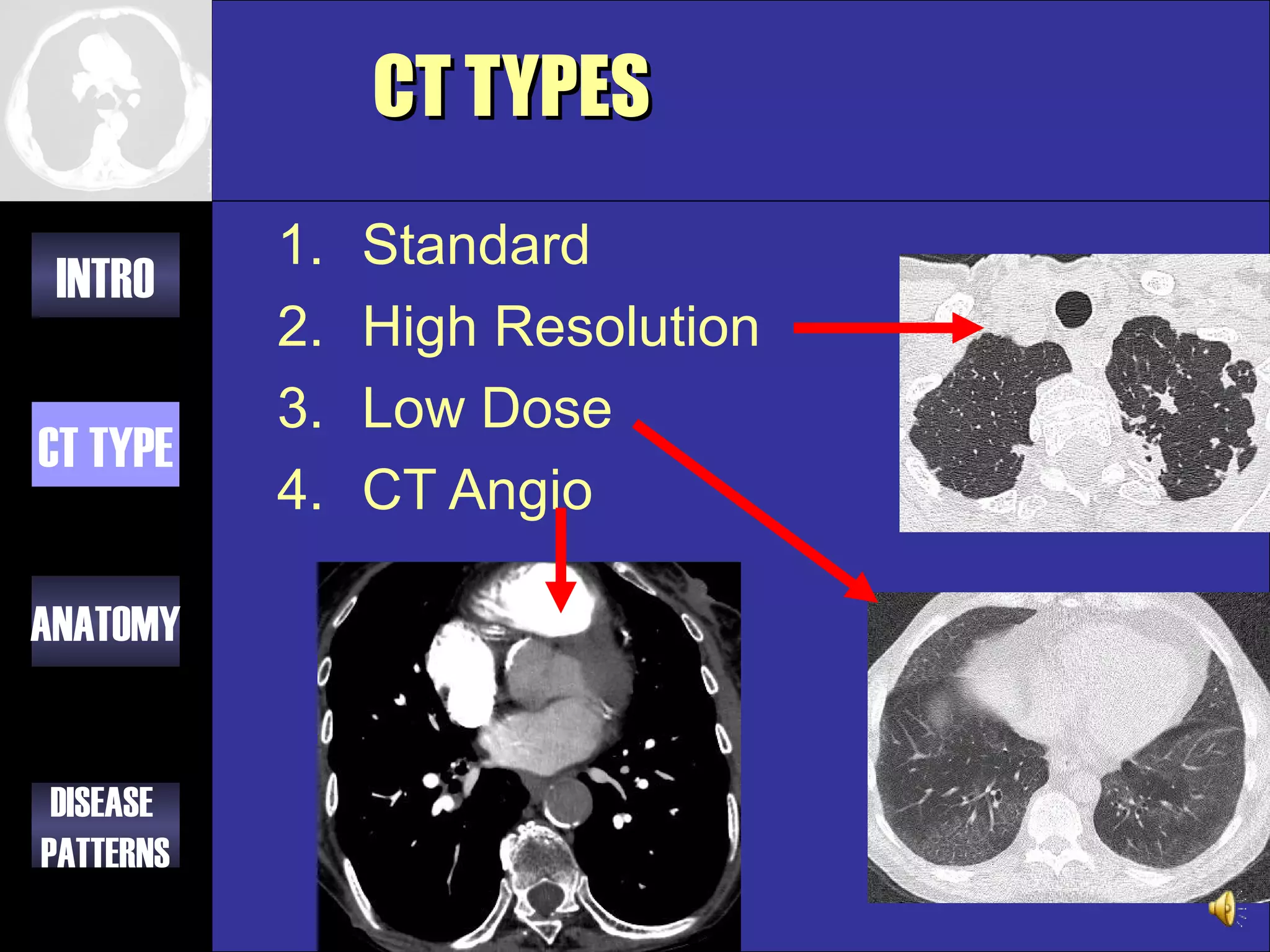Approach to ct chest 578 | PPT