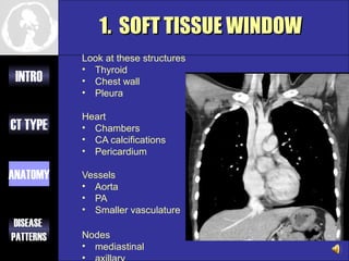 Approach to ct chest 578 | PPT