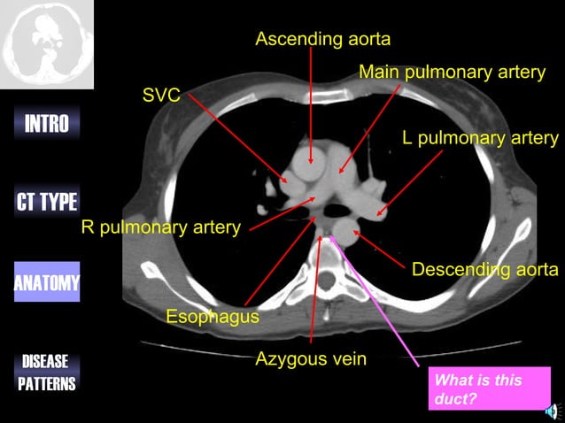 Approach to ct chest 578 | PPT | Lung and Respiratory Health | Diseases ...