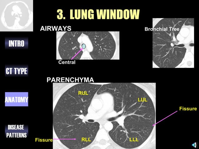 Approach to ct chest 578 | PPT | Lung and Respiratory Health | Diseases ...