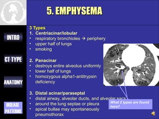 Approach to ct chest 578 | PPT