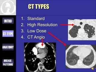Approach to ct chest 578 | PPT