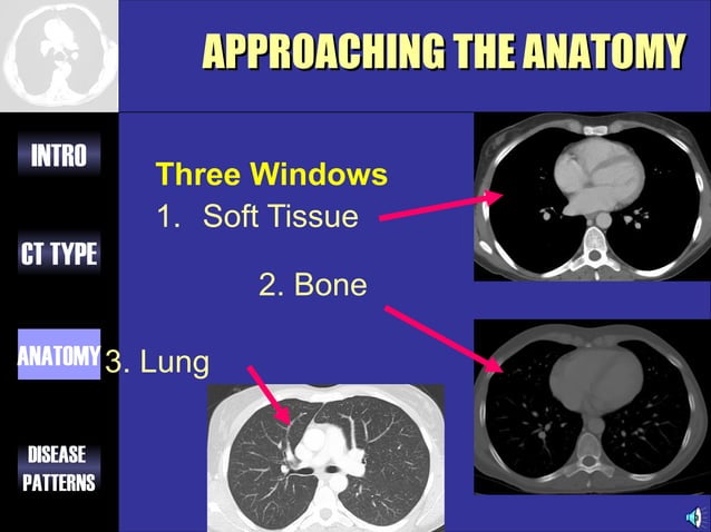 Approach to ct chest 578 | PPT | Lung and Respiratory Health | Diseases ...