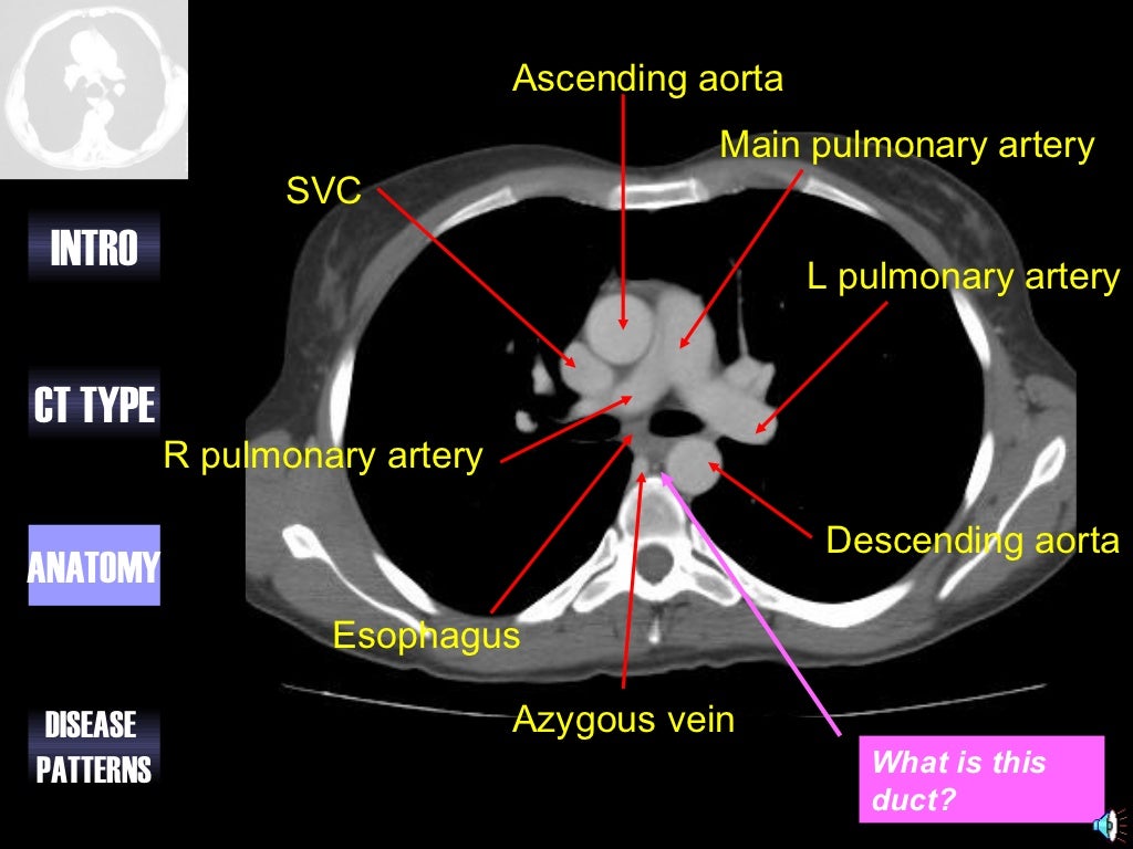 Approach To Ct Chest 578 Approach To Ct Chest 578