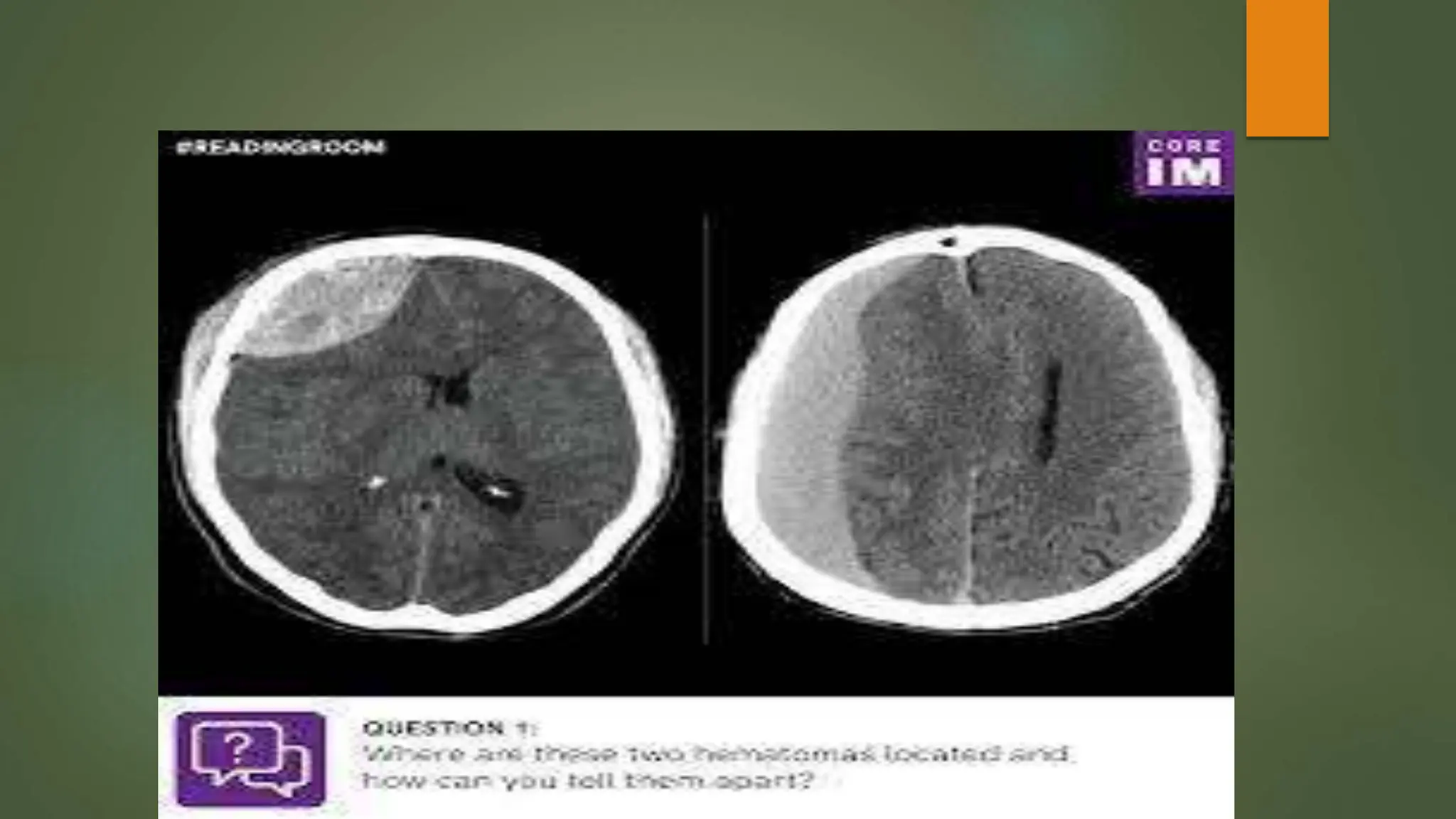 Approach to CT scan brain.pptx Uuuuuu | PPT