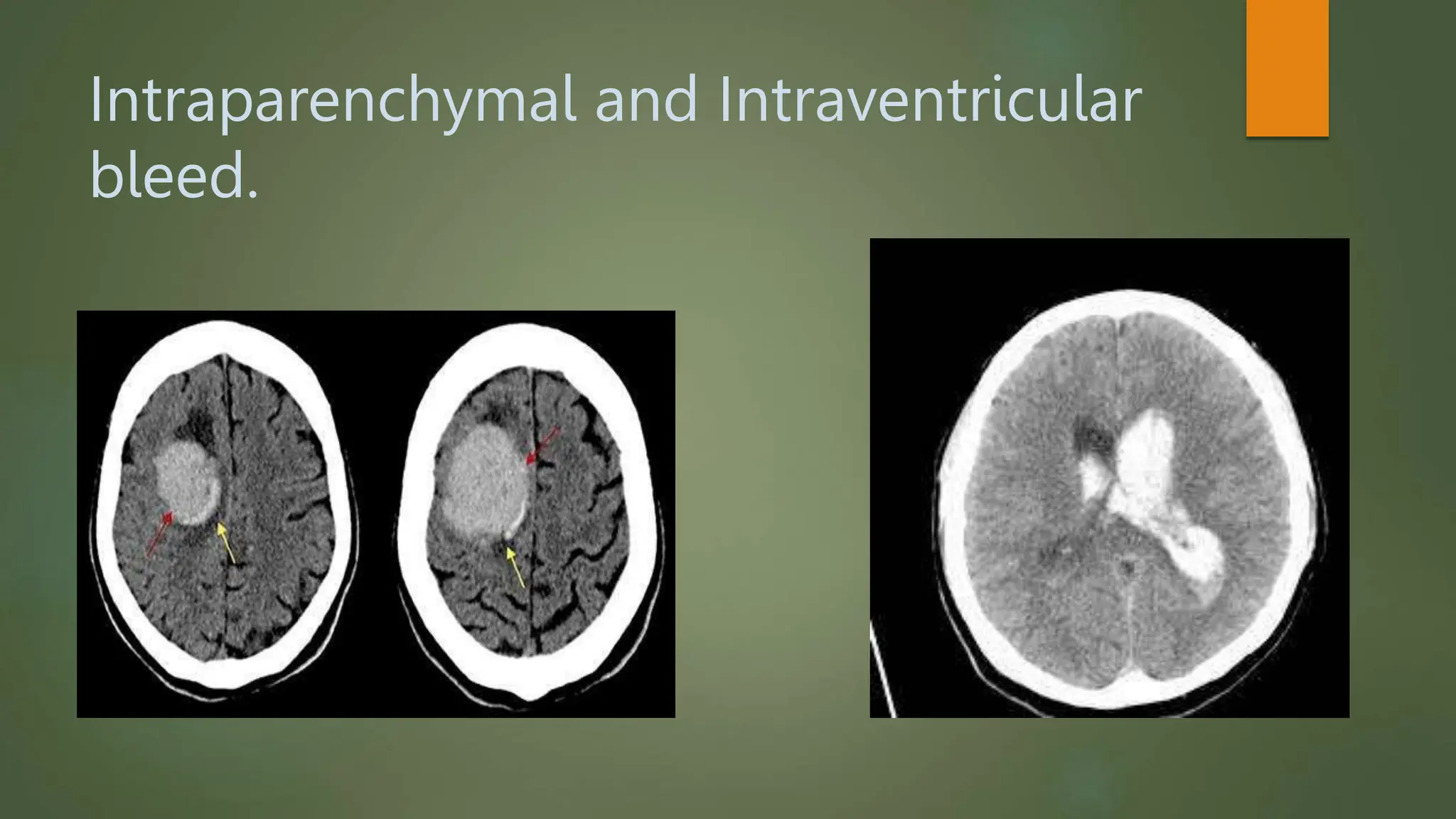 Approach to CT scan brain.pptx Uuuuuu | PPTX | Death, Injury, or Military Conflict | Sensitive ...