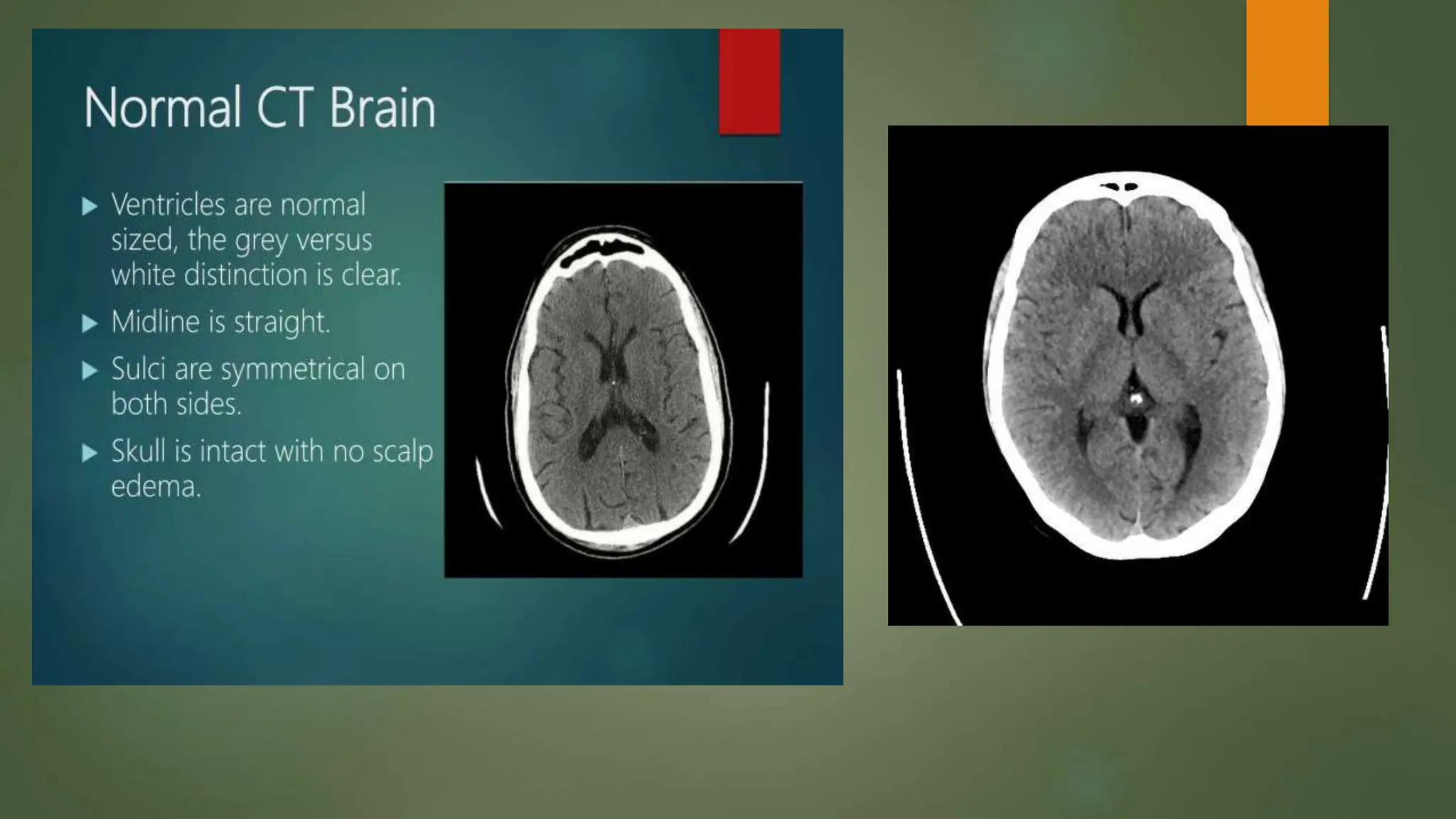 Approach to CT scan brain.pptx Uuuuuu | PPTX | Death, Injury, or Military Conflict | Sensitive ...
