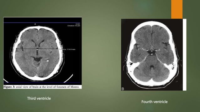 Approach to CT scan brain.pptx Uuuuuu | PPTX