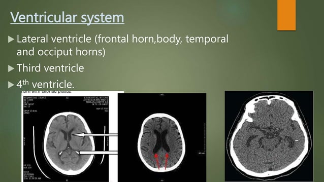 Approach to CT scan brain.pptx Uuuuuu | PPTX