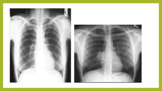 Approach to cxr | PPTX