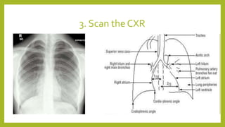 Approach to cxr | PPTX