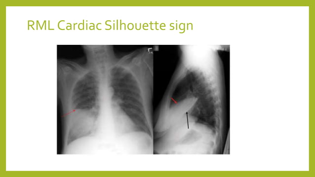 Approach to cxr | PPTX | Lung and Respiratory Health | Diseases and ...