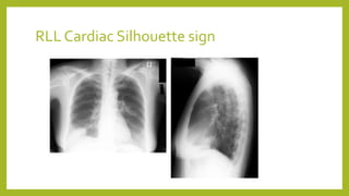Approach to cxr | PPTX