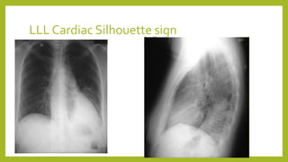 Approach to cxr | PPTX