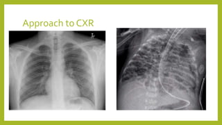 Approach to cxr | PPTX